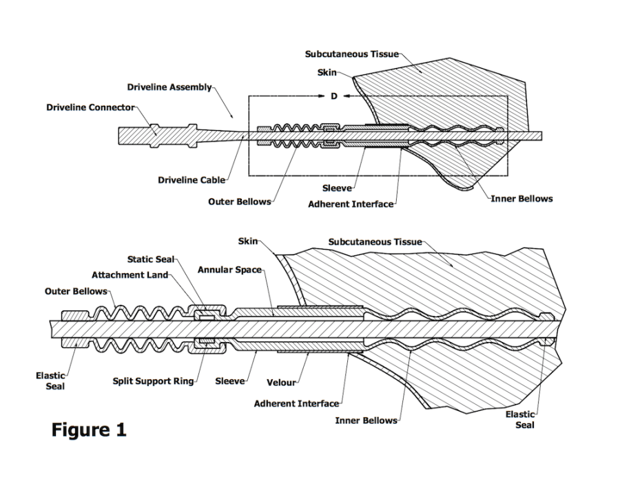 Ventricular Assist Device (VAD) Driveline Stress Reduction
