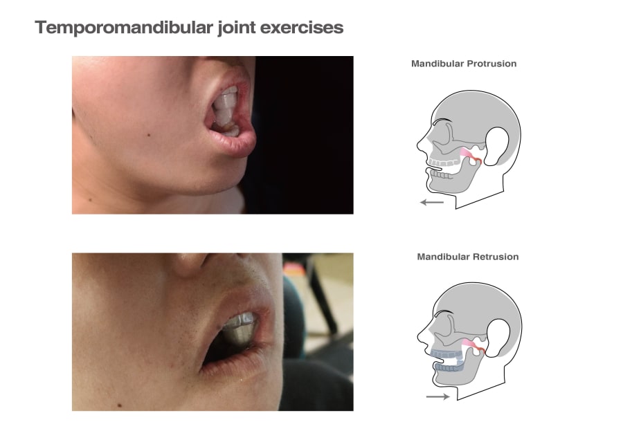 Novel EVA Trismus Rehabilitation Tray