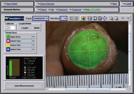 Digital Wound Measurement and Tracking System - Medical Design Briefs
