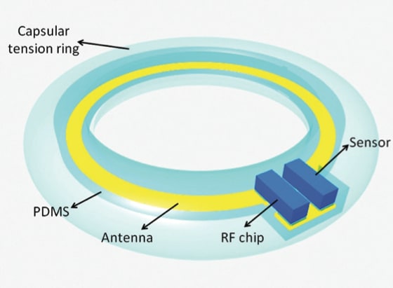 Permanent Eye Sensor Could Track and Monitor Glaucoma - Medical Design ...