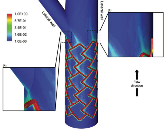 CFD Modeling and Visualization Aid Stent Research - Medical Design Briefs
