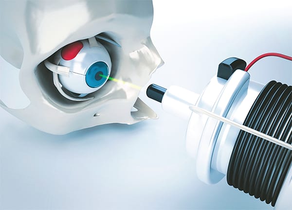Piezo Mechanisms Improve Refractive Eye Surgery - Medical Design Briefs