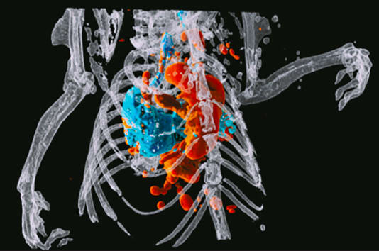 Transforming Cancer Imaging in Color - Medical Design Briefs