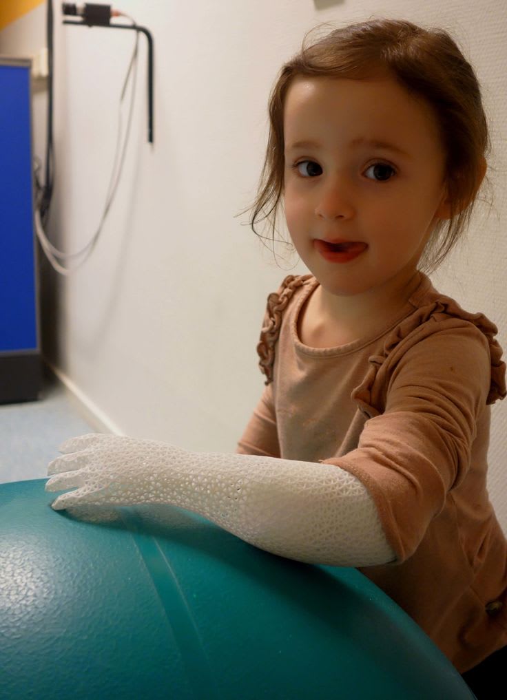 3D Printing a Perfectly Fitting Prosthetic Socket - Medical Design Briefs