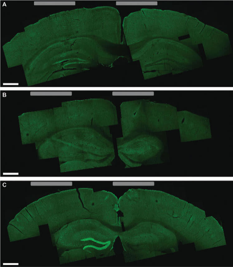 A Noninvasive Method for Deep Brain Stimulation - Medical Design Briefs