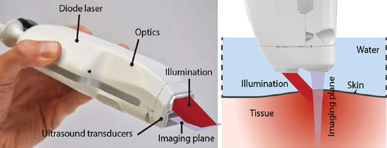 Device Combines Ultrasound and Photoacoustics to Improve Imaging ...