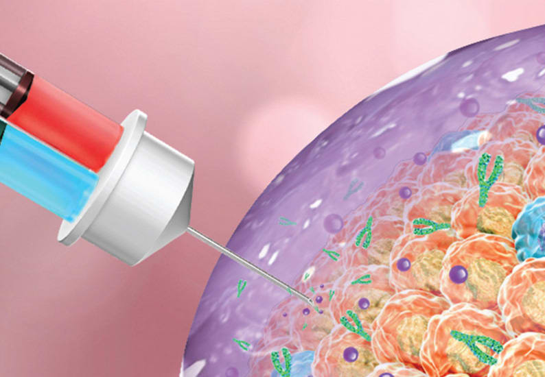 Therapeutic Gel Shows Promise Against Cancerous Tumors - Medical Design ...