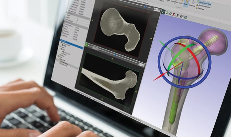 Customizing Implants With 3D Image Processing - Medical Design Briefs
