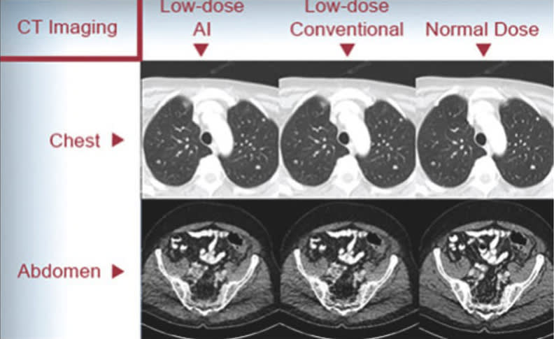 AI Enables Low-Dose CT Scans - Medical Design Briefs