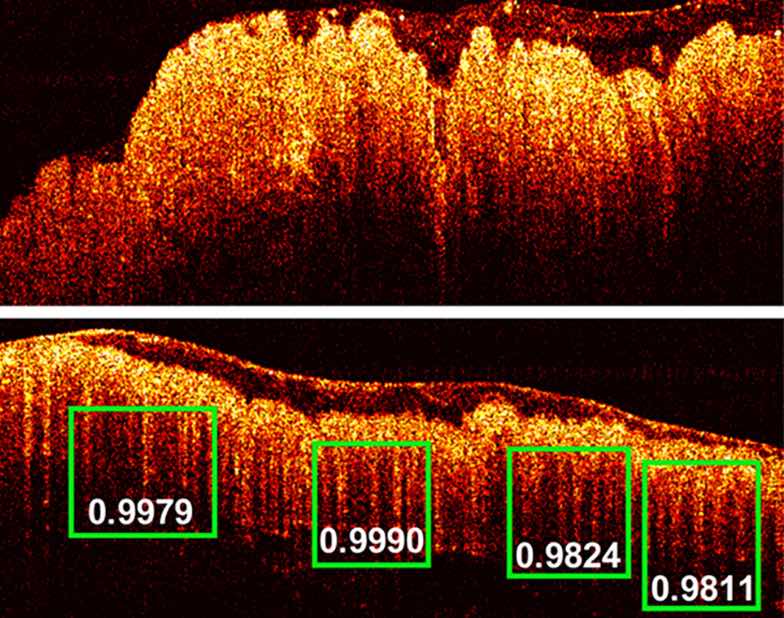 Machine Learning, Imaging Technique May Boost Colon Cancer Diagnosis ...
