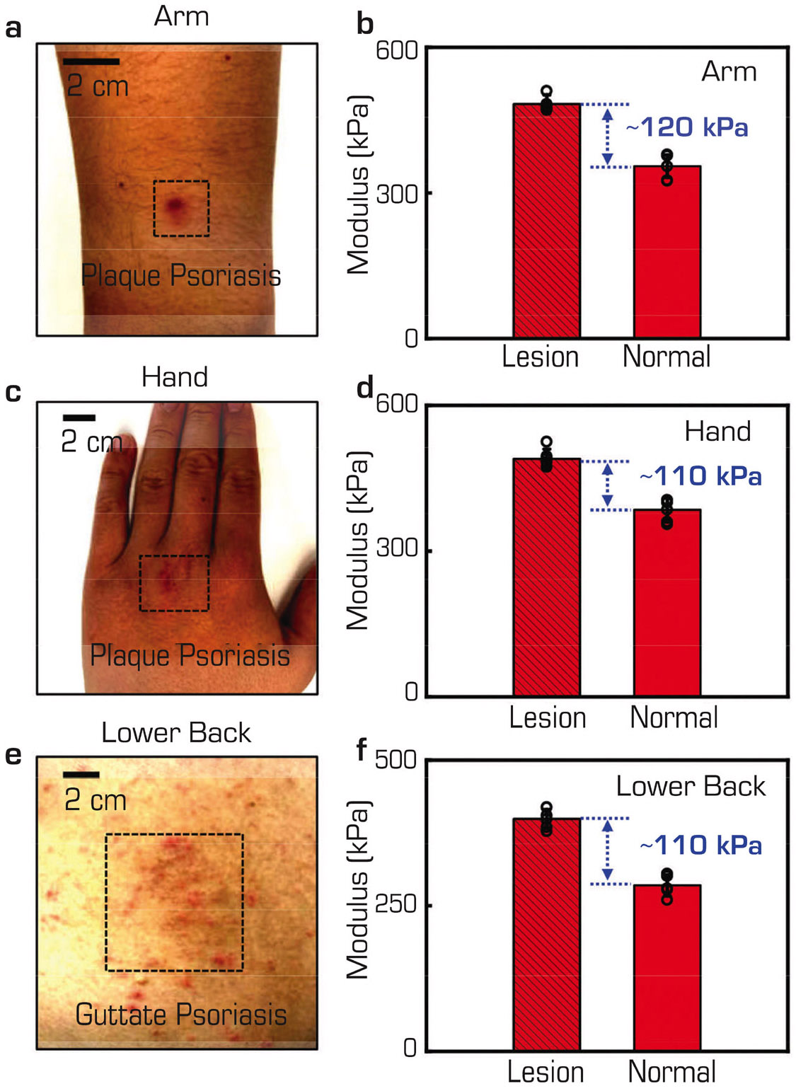 Soft Sensing Device Detects Skin Disorders Based on Tissue Stiffness ...
