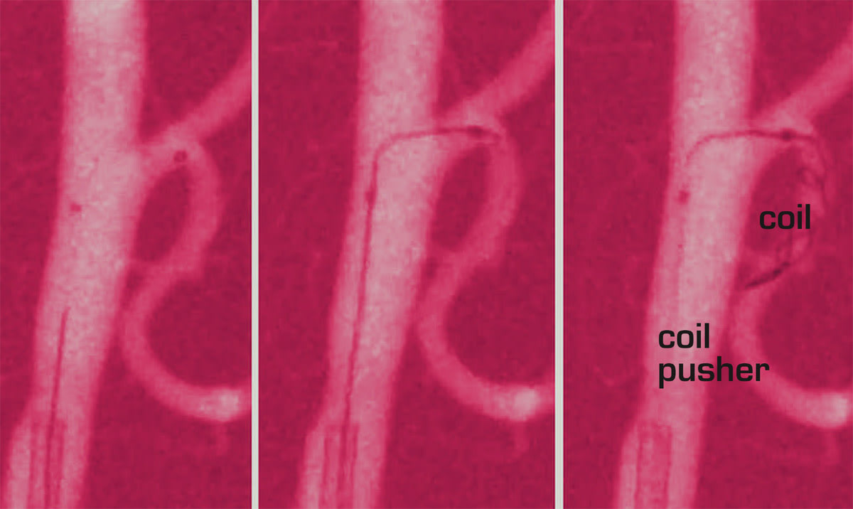 First Steerable Catheter Developed for Brain Surgery - Medical Design ...