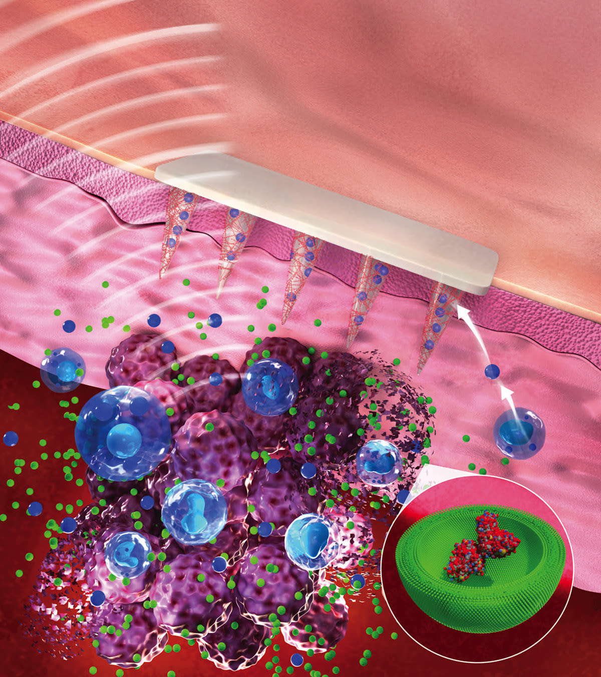 Moving the Needle on Monitoring Skin Cancer - Medical Design Briefs