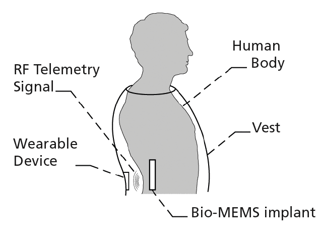 Wearable Wireless Telemetry System for Implantable BioMEMS Sensors ...