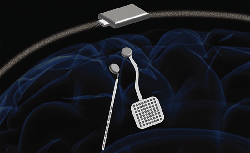 Wireless “Pacemaker” for the Brain - Tech Briefs