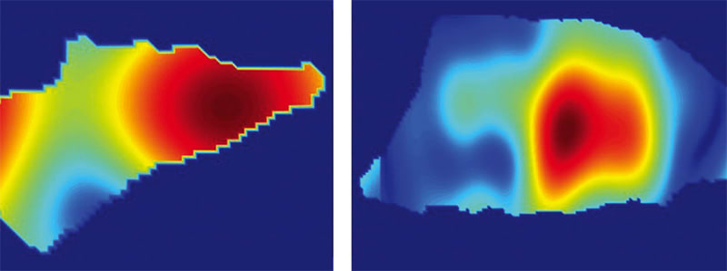 Handheld Device Diagnoses Skin Cancer - Tech Briefs