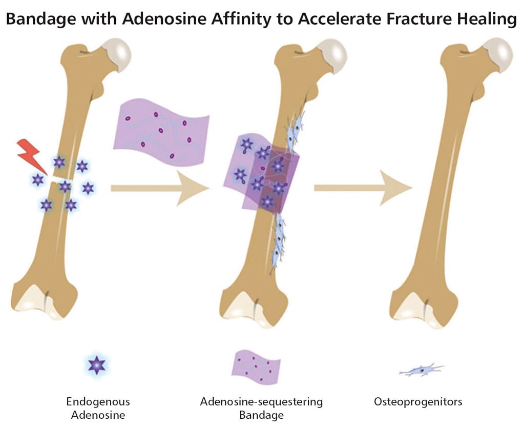 Bone Bandage Accelerates Repair - Tech Briefs
