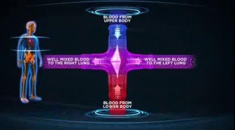 NASA Motor Technology Now Helps Pump Children's Hearts - Tech Briefs