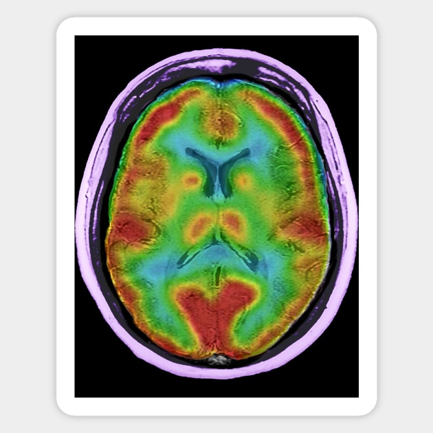 Normal brain blood flow, MRI and SPECT (C026/8000) - Coloured - Sticker ...