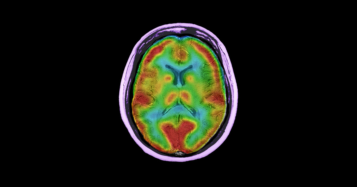Normal brain blood flow, MRI and SPECT (C026/8000) - Coloured - Sticker ...