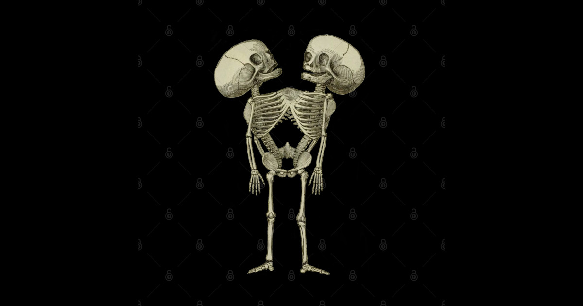 Siamese Twins Skeleton - Siamese - Sticker | TeePublic