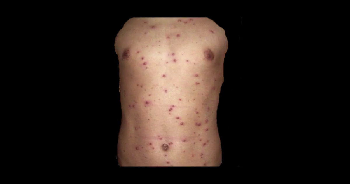 Chickenpox - Illness - Sticker | TeePublic