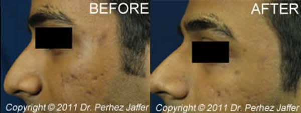 ematrix Sublative Rejuvenation Vancouver - Superior Results ...