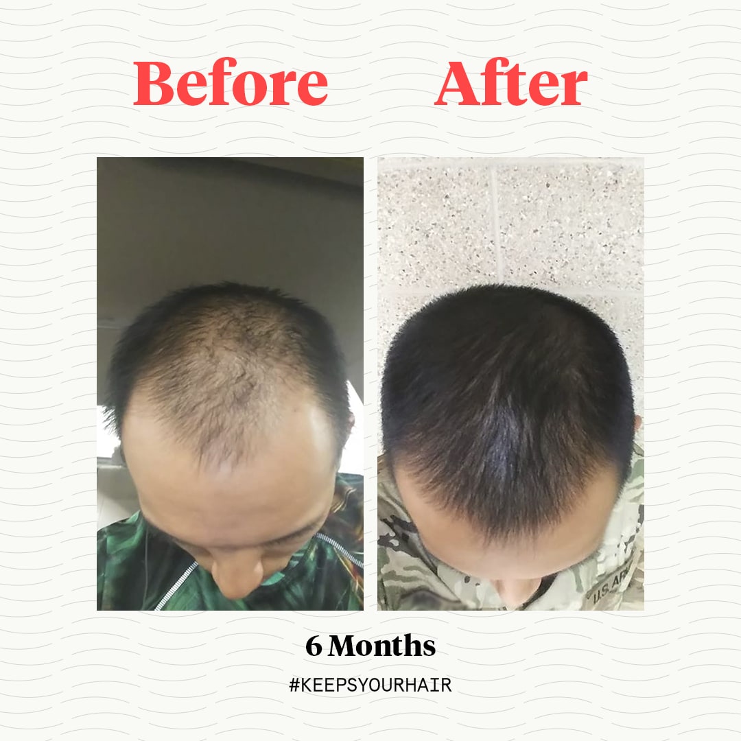 Keeps Hair Loss Treatment Reviews