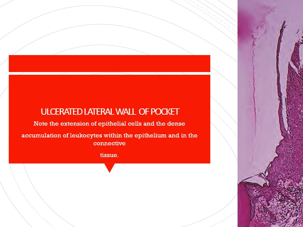 A presentation on periodontal pockets | Upwork