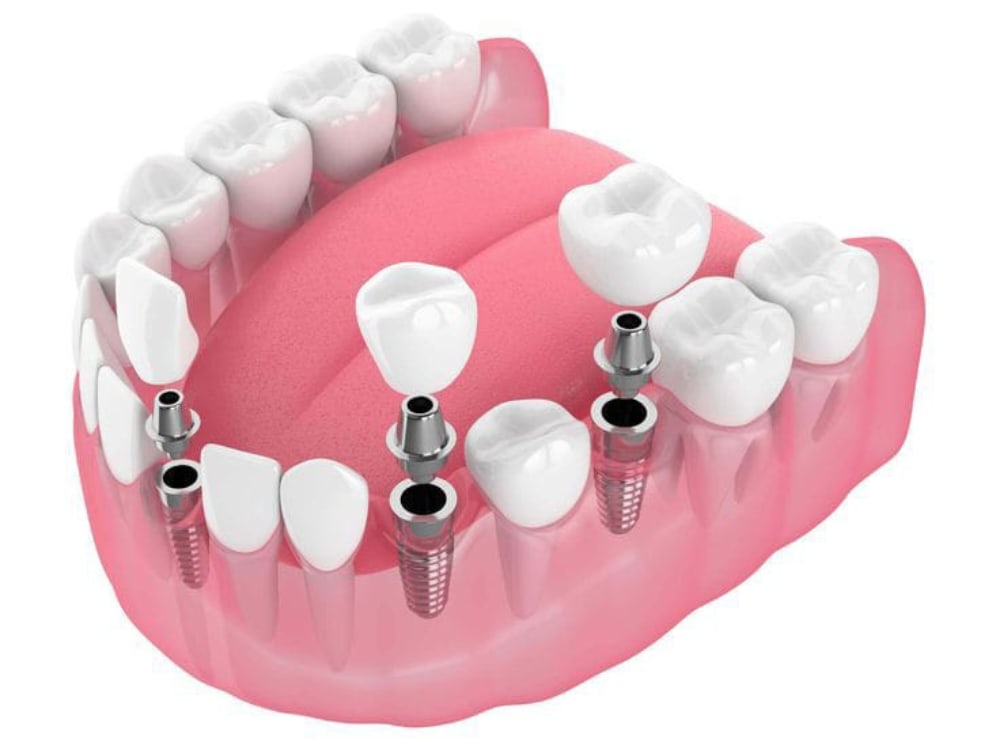 3d dental animation 3d medical animation 3d dental video with HD ...