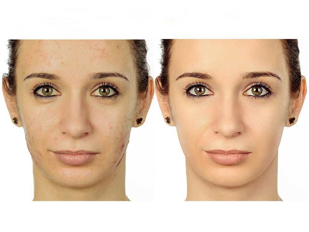 Headshot, portrait, skin, pimple, and natural beauty retouch in ...