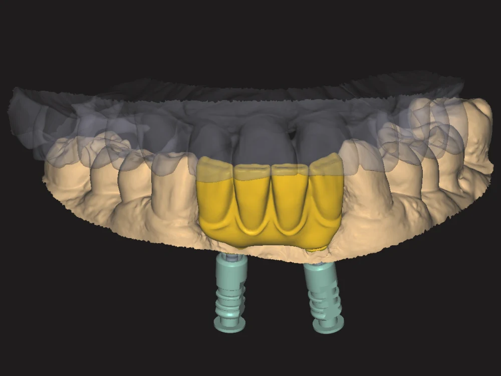 Good and functional crown and bridge for your cases | Upwork