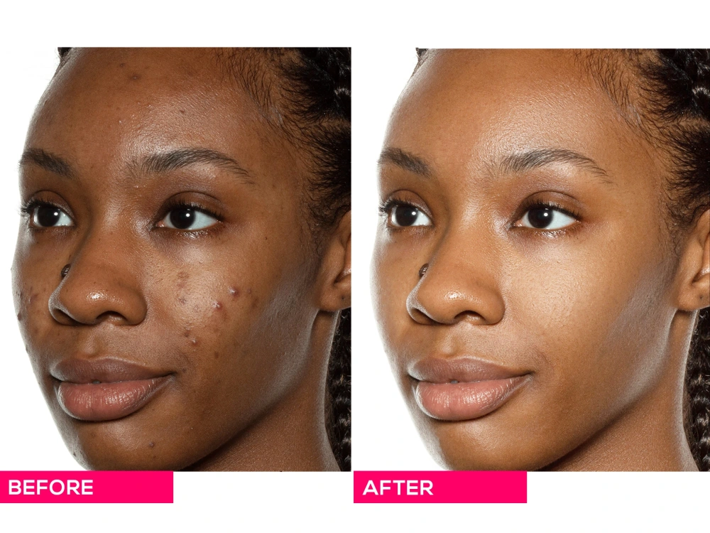 Professional skin retouching done in photoshop | Upwork