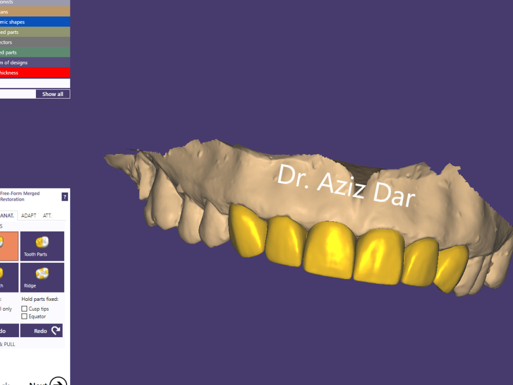 Dental Designs Dream Smile - 3D (STL), Exocad Crowns/Bridges/Implants ...