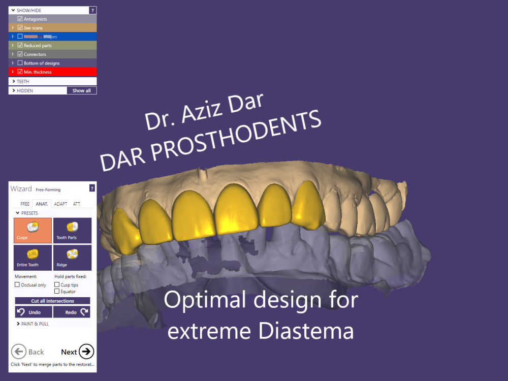 Dental Designs Dream Smile - 3D (STL), Exocad Crowns/Bridges/Implants ...