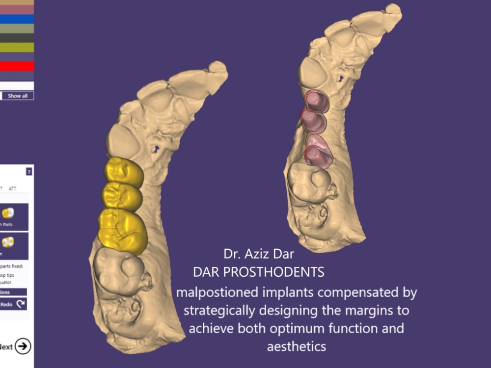 Dental Designs Dream Smile - 3D (STL), Exocad Crowns/Bridges/Implants ...