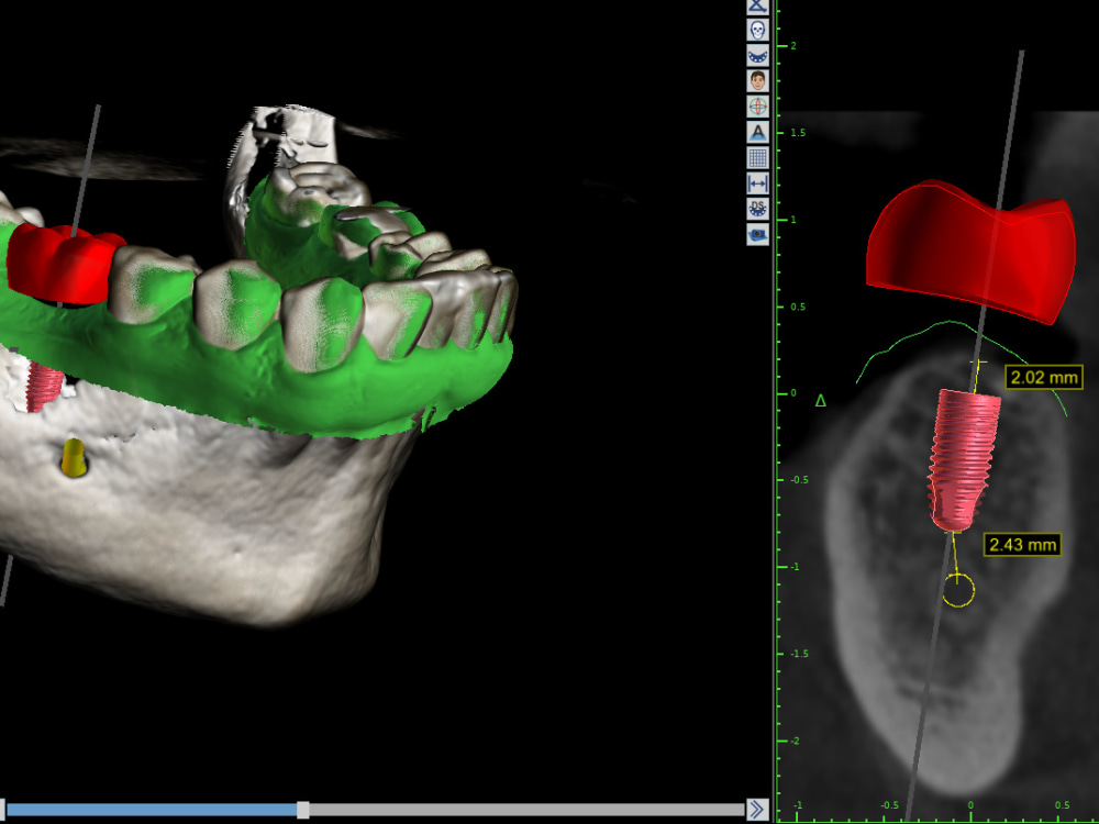 A dental implant surgical guide | Upwork