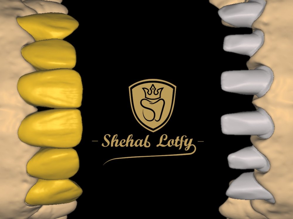 A high-quality Exocad dental digital design Veneers, Bridges and Crowns ...