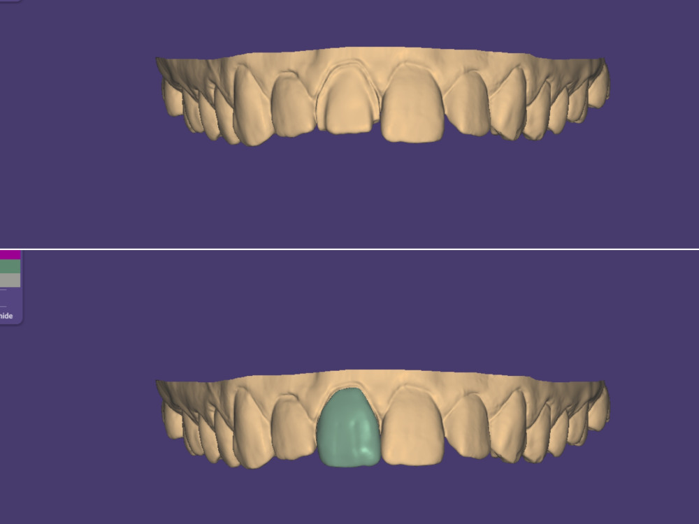 A high-quality Exocad dental digital design Veneers, Bridges and Crowns ...