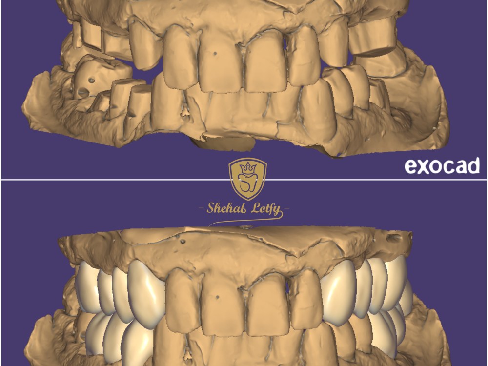 A high-quality Exocad dental digital design Veneers, Bridges and Crowns ...