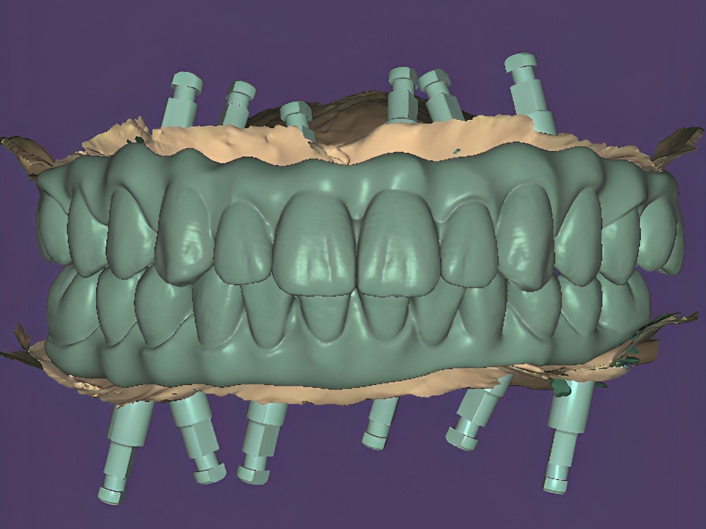A high-quality Exocad dental digital design Veneers, Bridges and Crowns ...