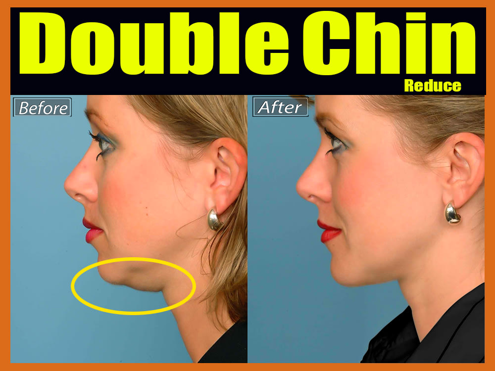 Reduce double chin - Chin remove - Jawline fixing | Upwork
