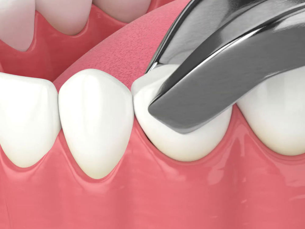 3d Dental animation 3d surgery 3d medical animation and explainer video ...