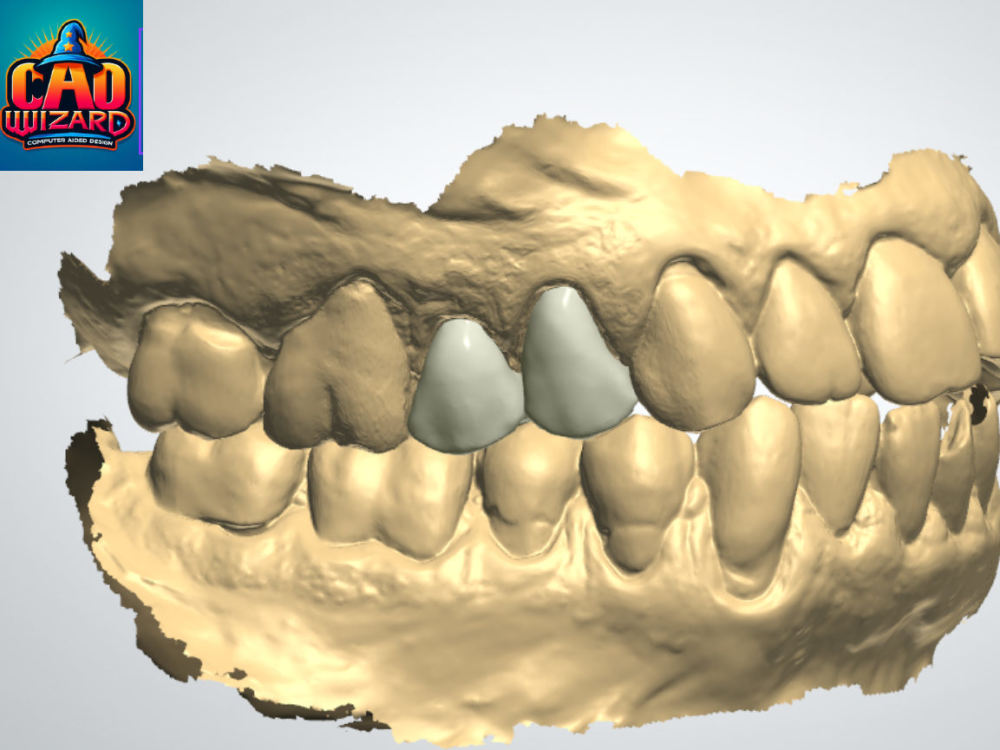 3Shape Dental Design | Crowns, Implants, Bridges, Inlays/Onlays, Models ...