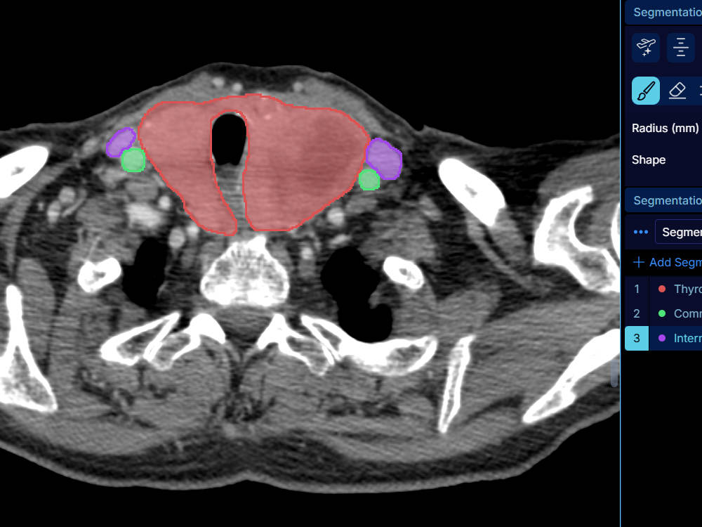 Radiologist for CT, MRI, USG Annotations | DICOM, 3D Slicer, MD.ai | Upwork