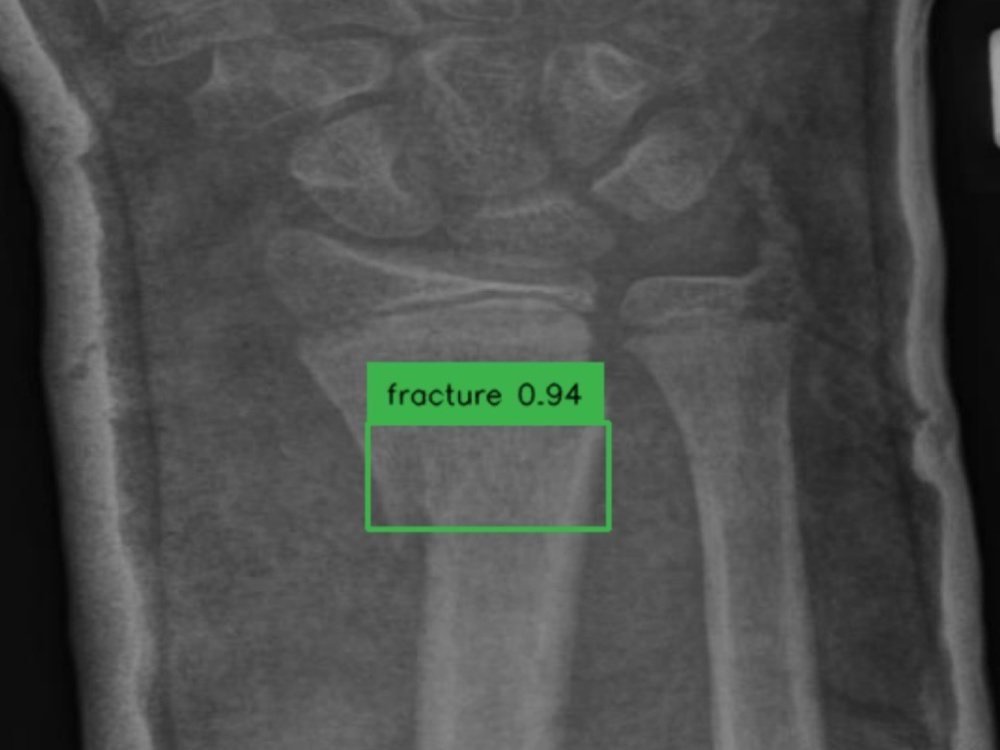 AI X-Ray Fracture Detection | Custom Vision Models (DETR, YOLO, R-CNN ...