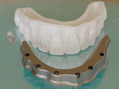 Design 3d dental bar substructure | Upwork