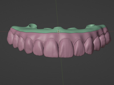 Separated I-Bar from Hybrid Prosthesis | Upwork