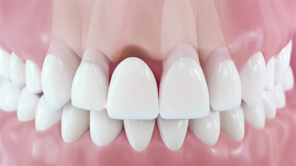 Aesthetic dental animation 3d medical animation 3d animation for ...