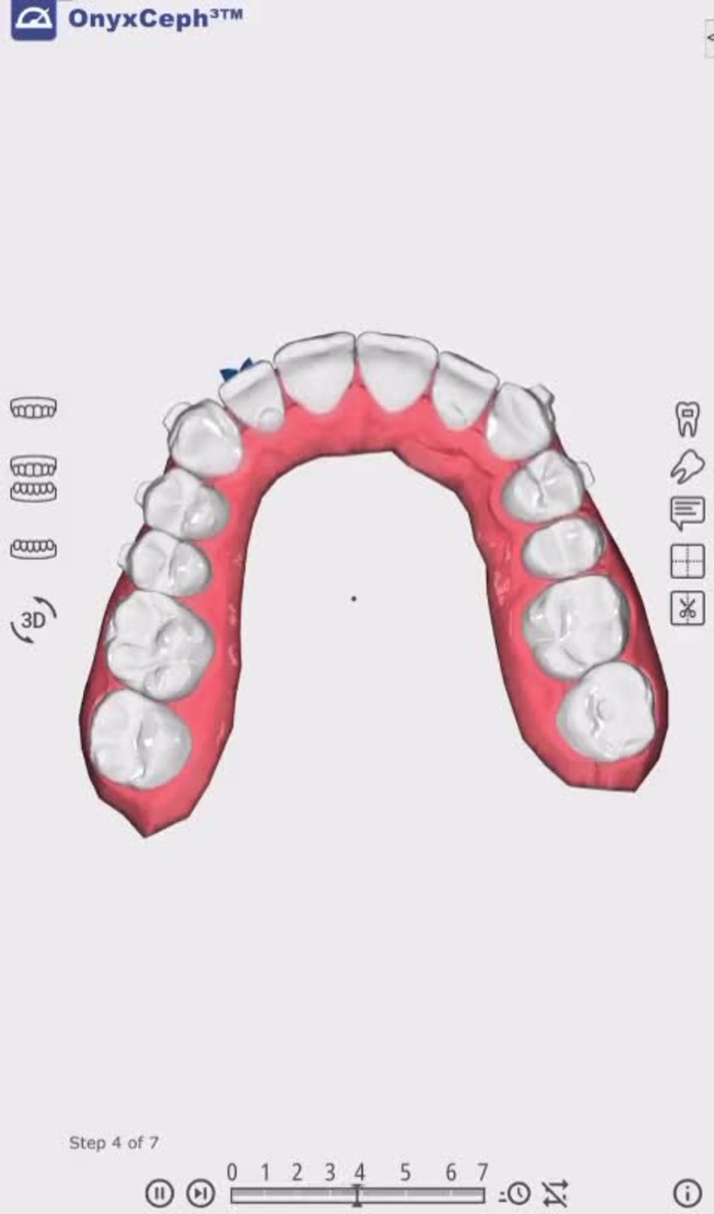 Clear aligner treatment plans planned on onyxceph | Upwork